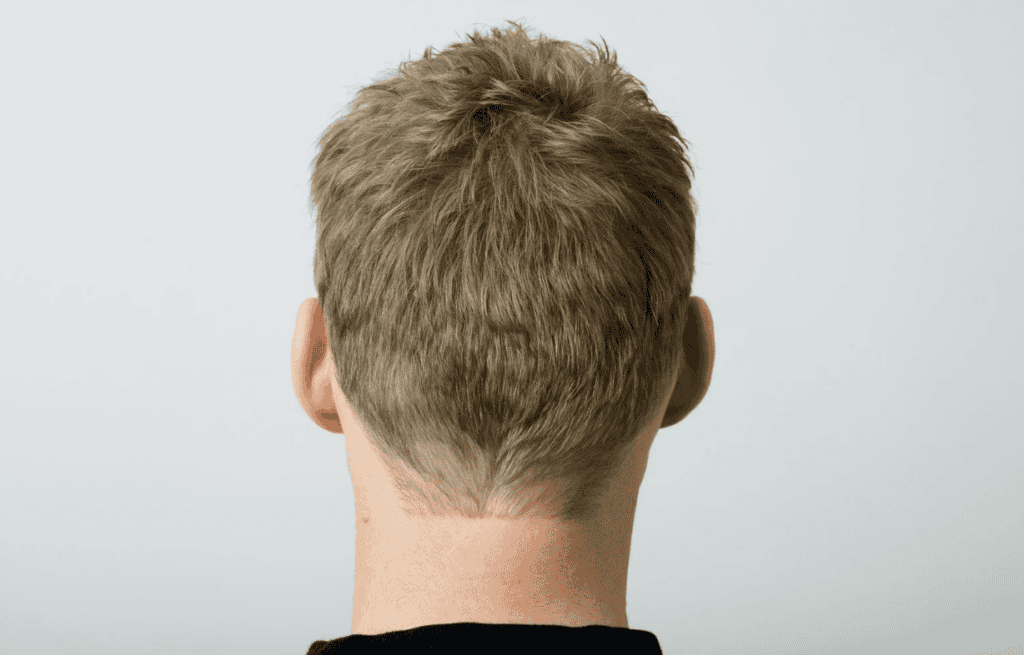 Understanding TMS Treatment: A Look at Potential Side Effects - Shanti TMS